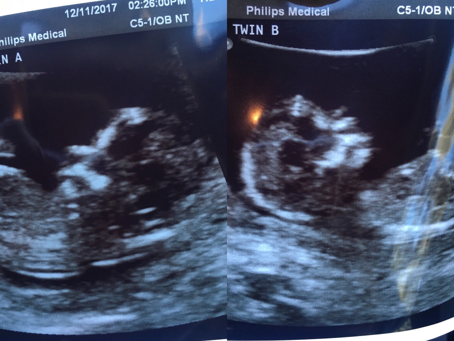 Twin Pregnancy – Marvelous Mrs. Morin